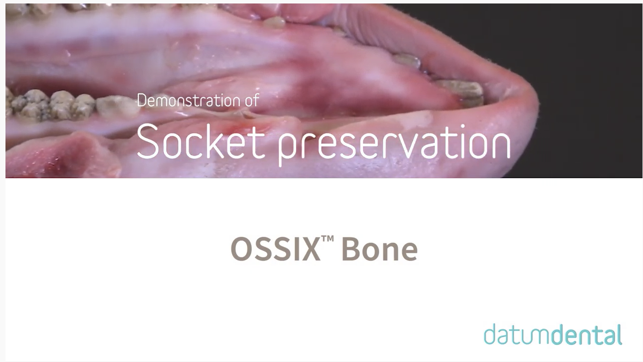 Ossix® Plus - Reasorbable Collagen Dental Membrane - Implantology And ...
