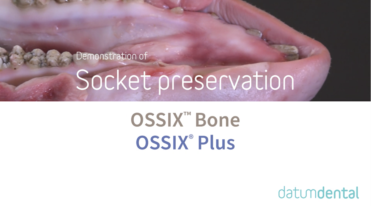 Ossix® Plus - Reasorbable Collagen Dental Membrane - Implantology And ...