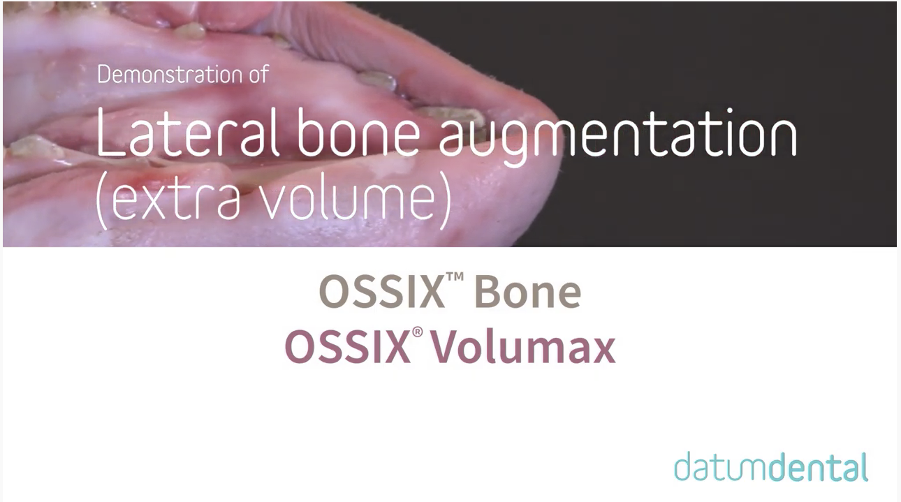 Ossix® Plus - Reasorbable Collagen Dental Membrane - Implantology And ...