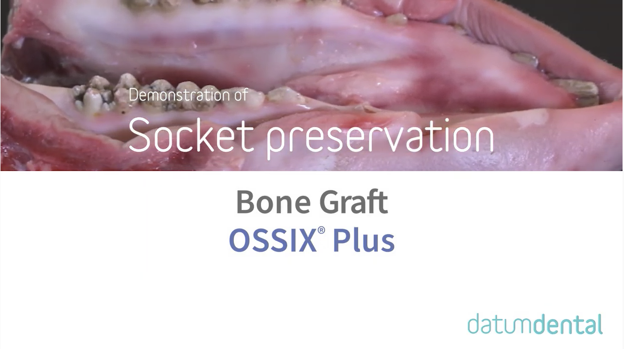 Ossix® Plus - Membrana Riassorbibile A Base Di Collagene Reticolato ...