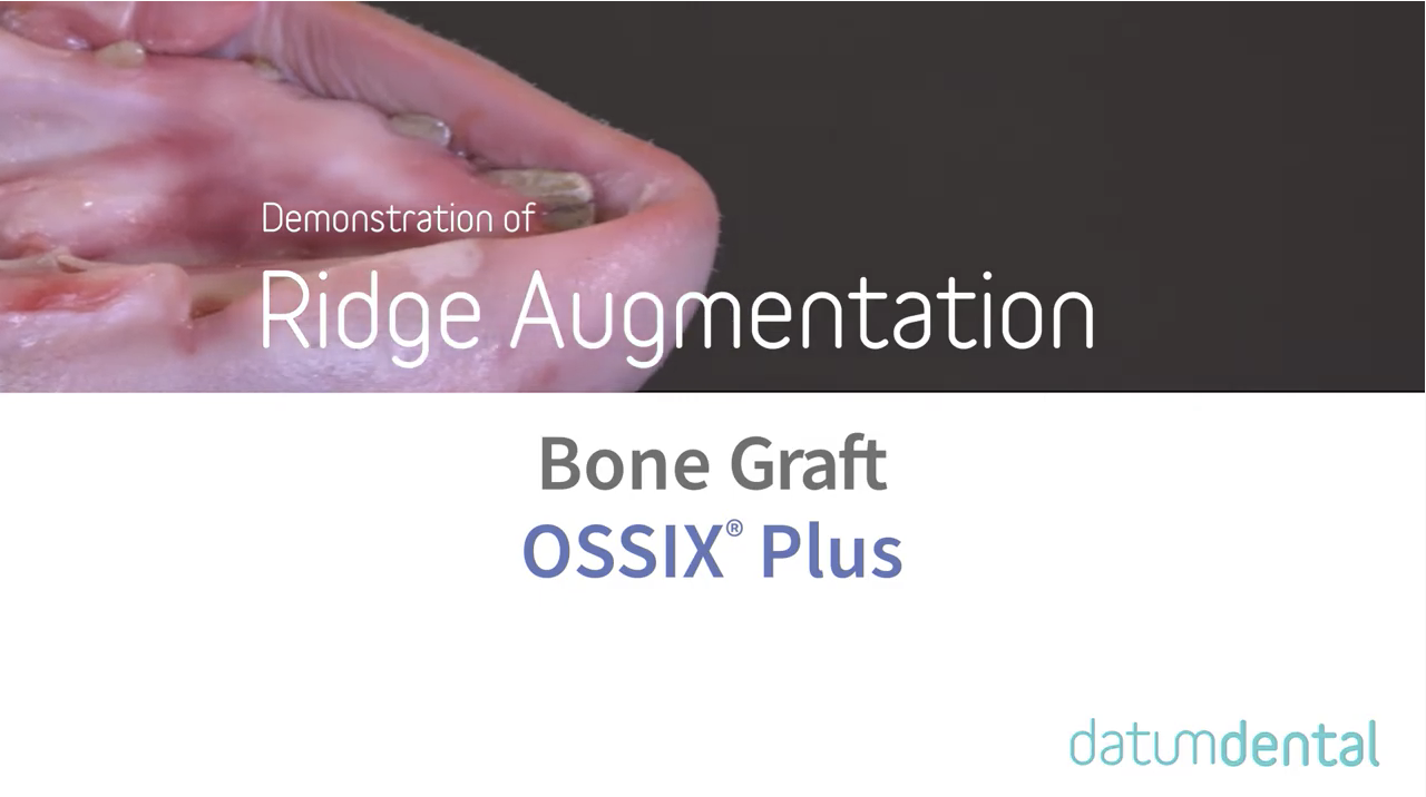 Ossix® Plus - Membrana Riassorbibile A Base Di Collagene Reticolato ...