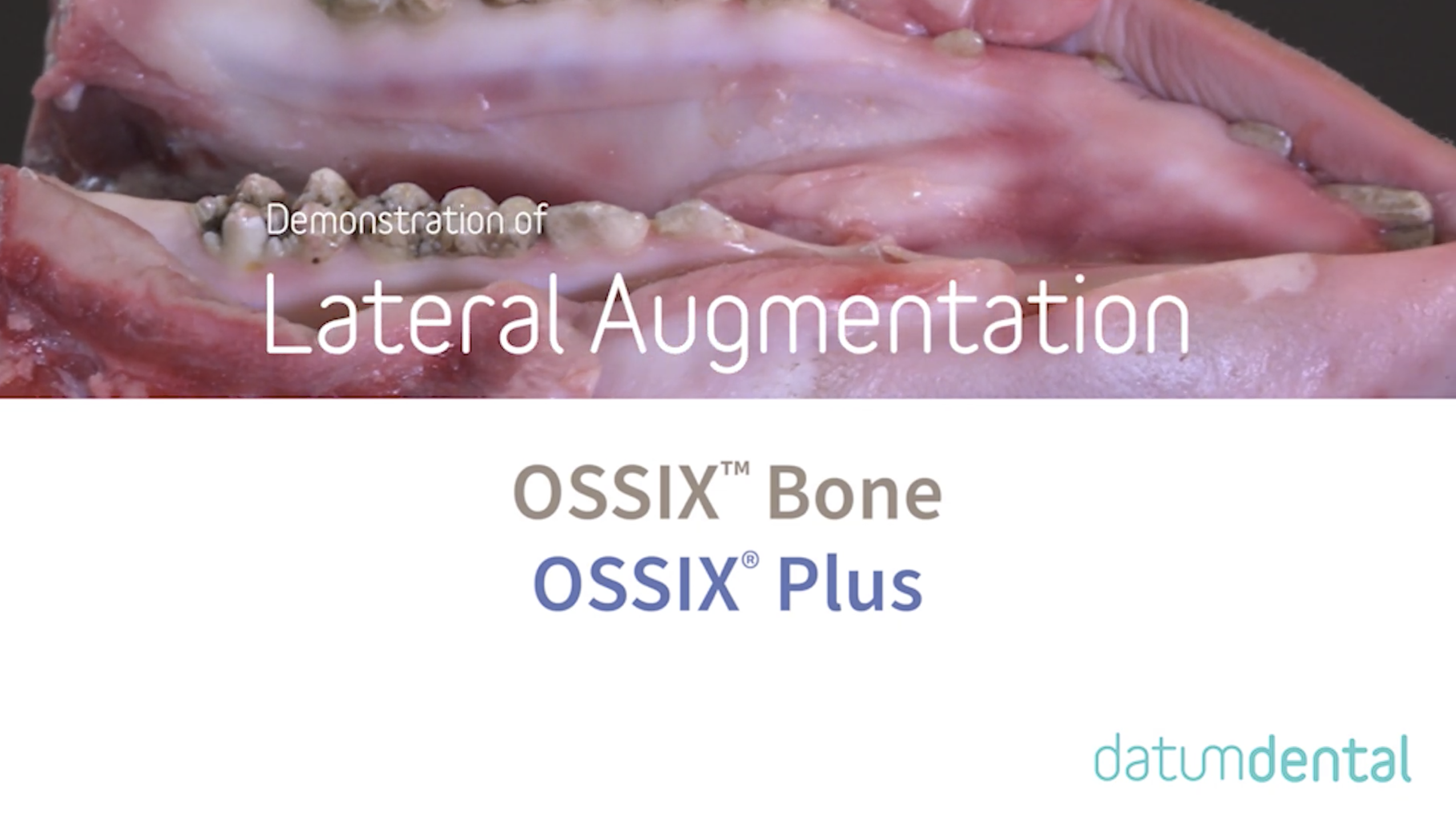 Ossix® Plus - Membrana Riassorbibile A Base Di Collagene Reticolato ...