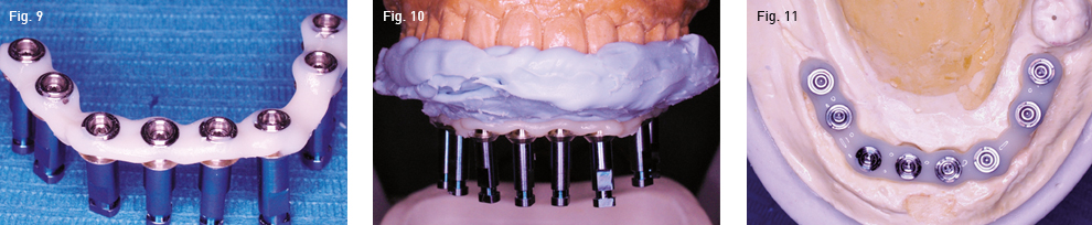 Tecnica "simple" E Carico Immediato Di Una Cresta Mandibolare Edentula ...