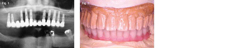 Tecnica "simple" E Carico Immediato Di Una Cresta Mandibolare Edentula ...