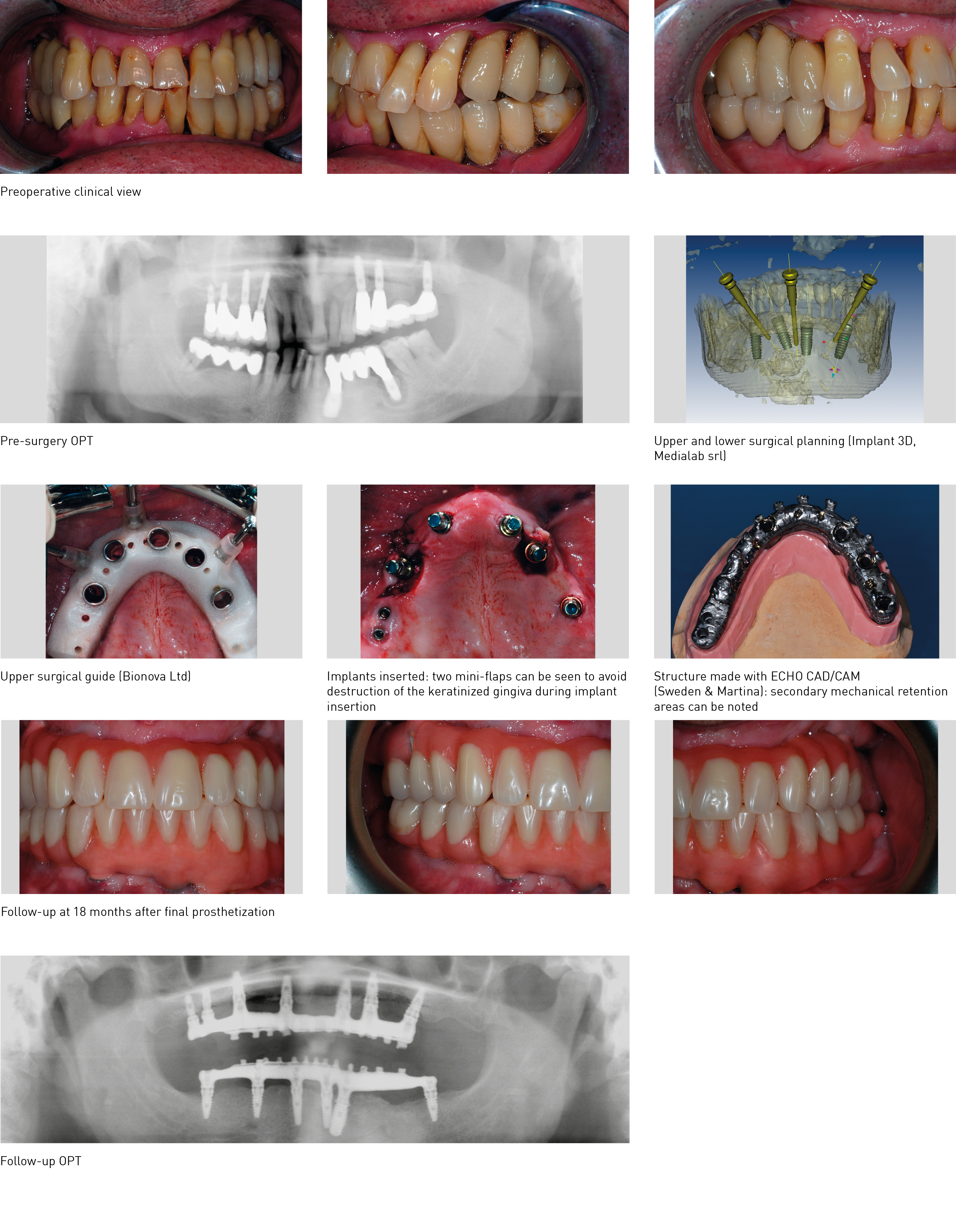 Implant-supported Rehabilitation Of Both Edentulous Jaws With Immediate ...