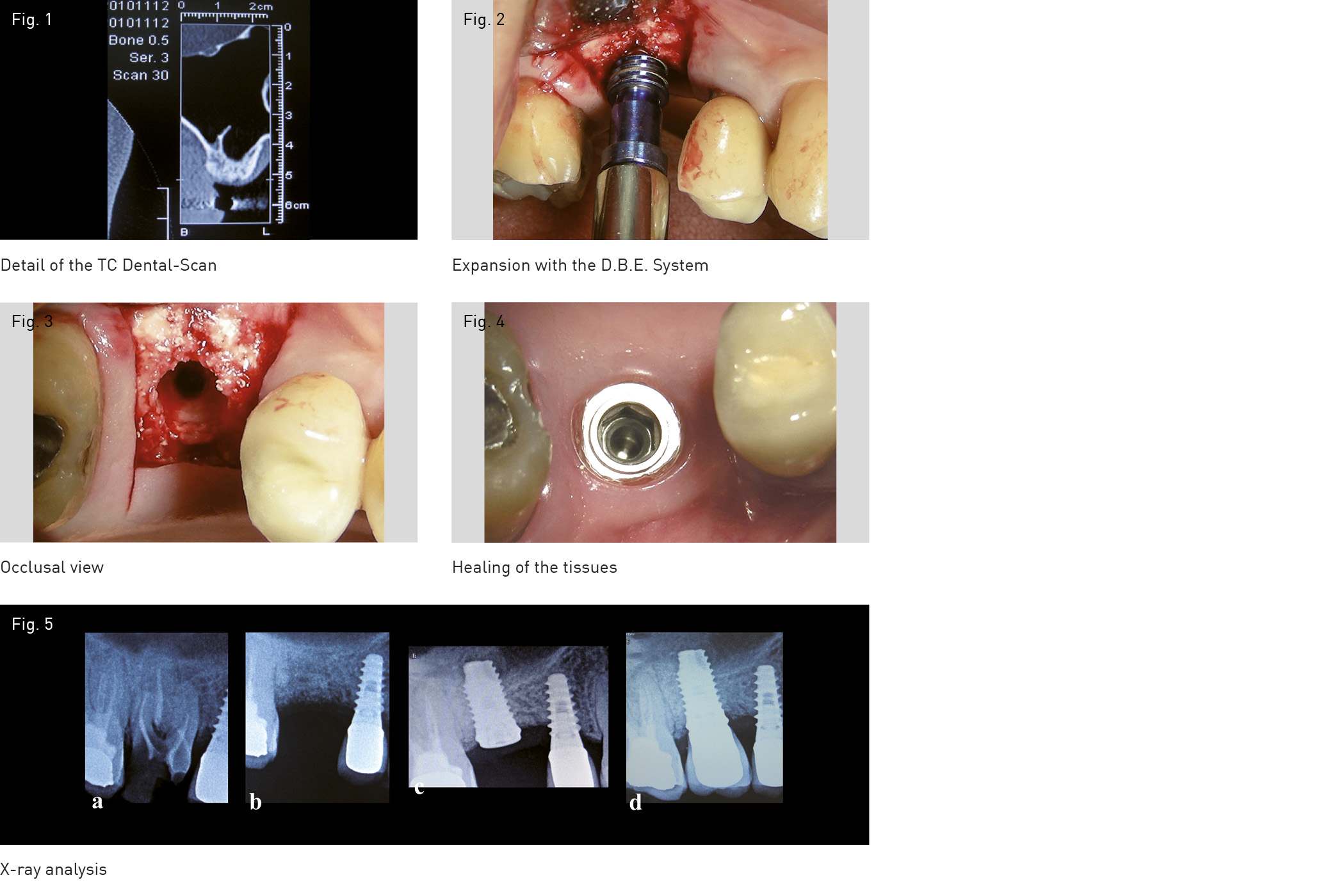Controlled Bone Expansion With The Drill Bone Expander (d.b.e ...
