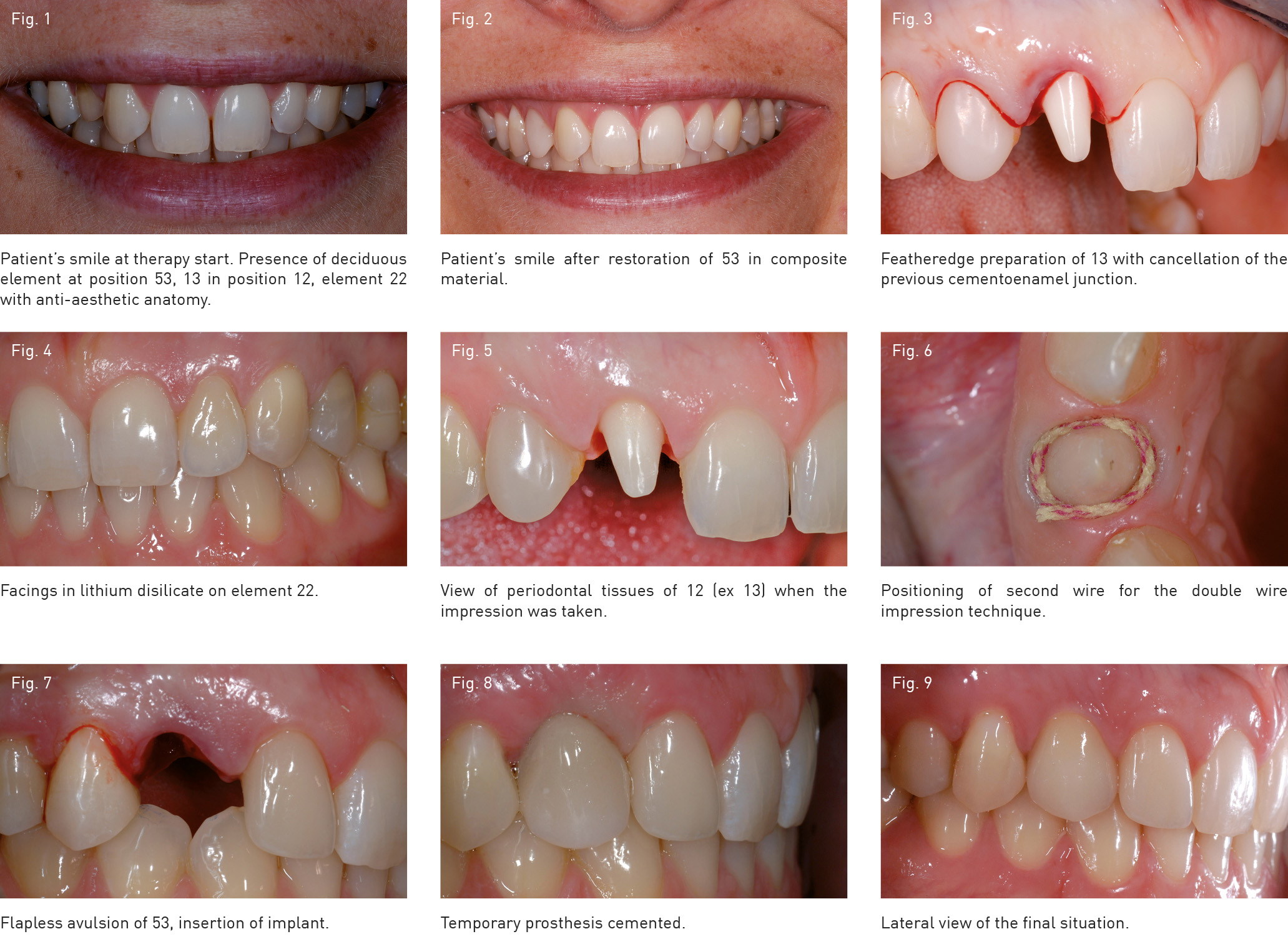 Prosthetic Orthodontics Using The Biologically Oriented Preparation ...