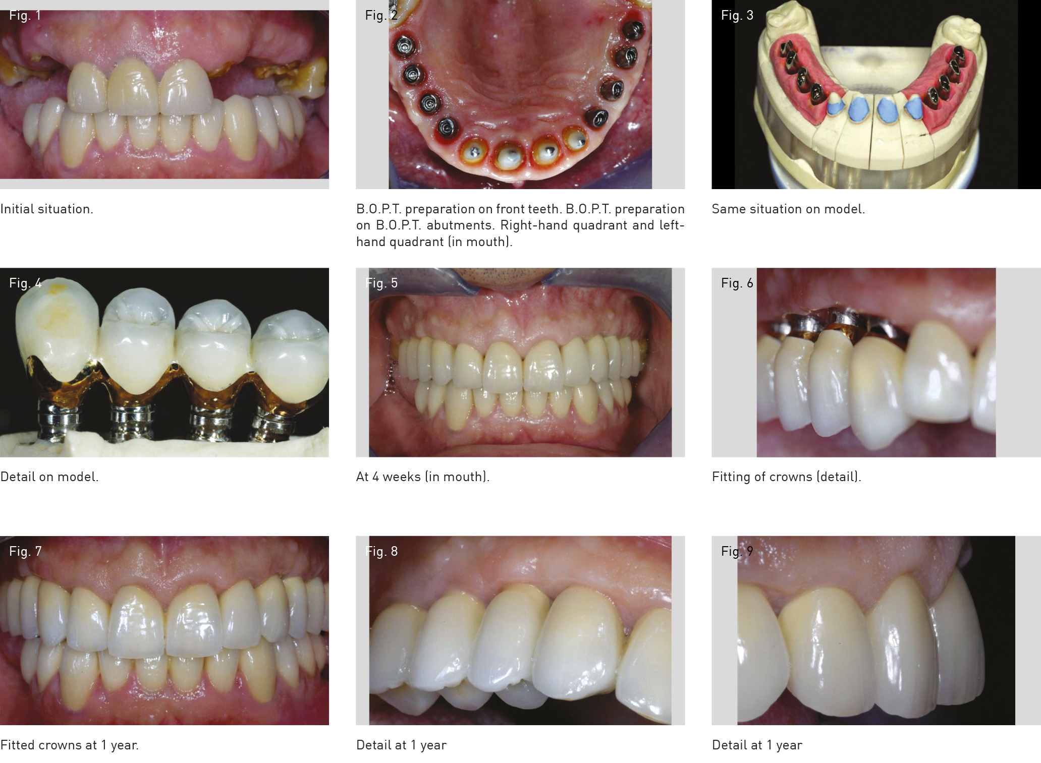 Biologically Oriented Preparation Technique (b.o.p.t.) On Teeth And ...