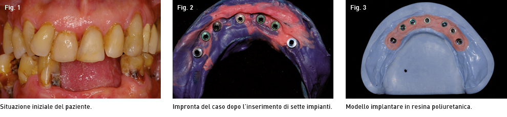 Materiali E Tecnologie Innovative In Ambito Implanto-protesico | Sweden ...