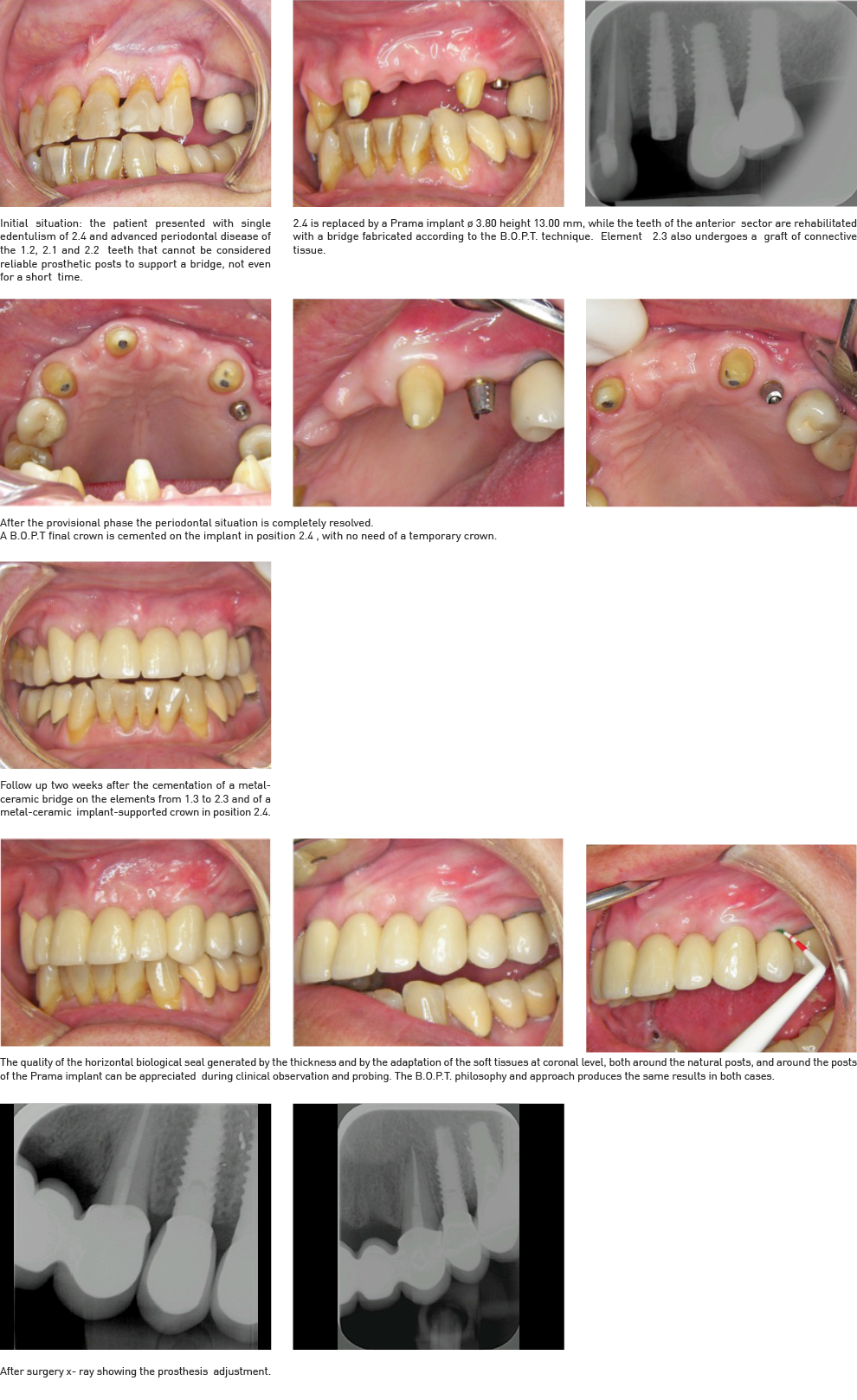 Clinical Case: Prosthetic Seal With The B.o.p.t. Technique From Natural ...