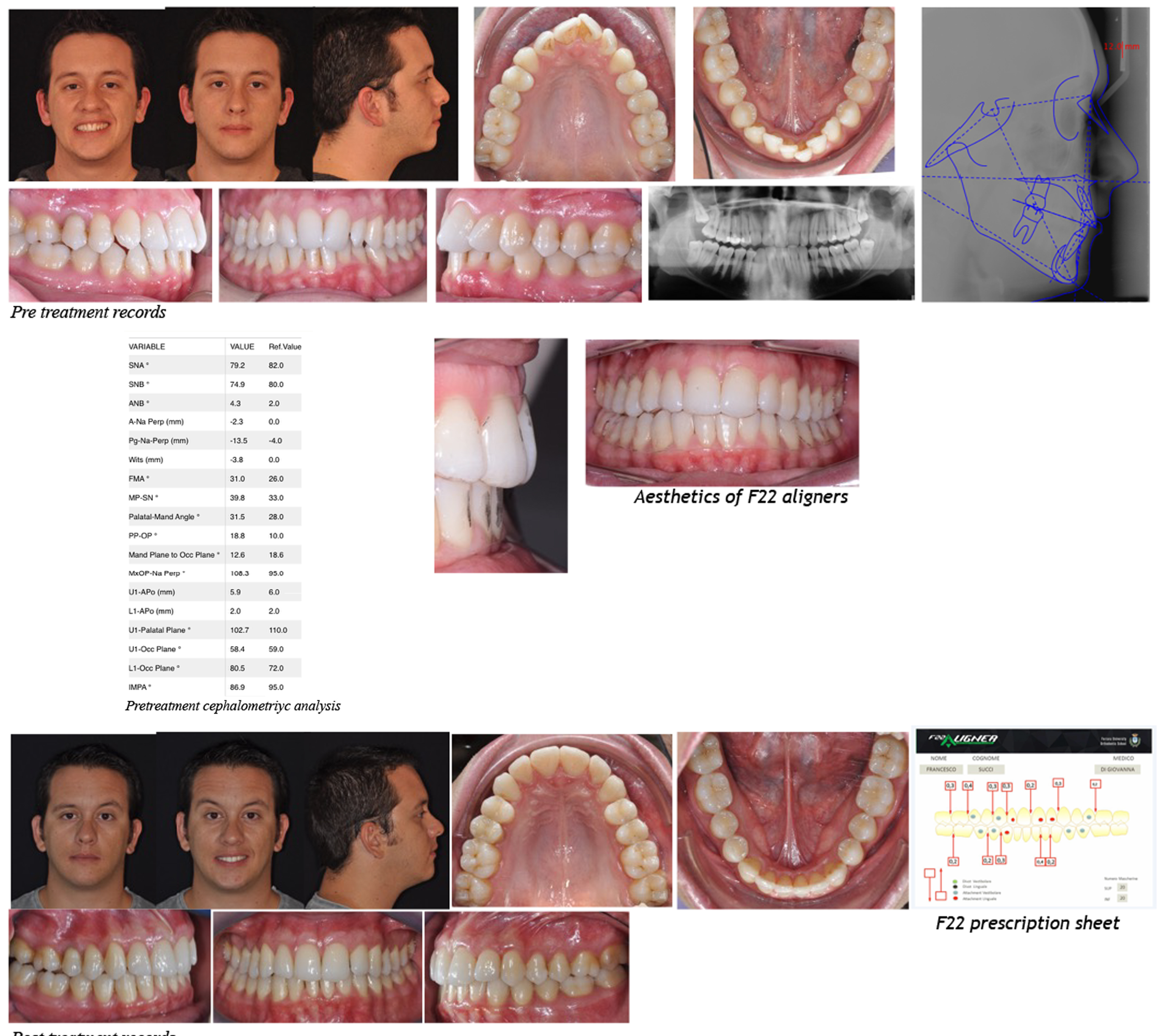 Effectiveness Of F22 Aligner In Correcting Severe Tooth Rotation: A ...